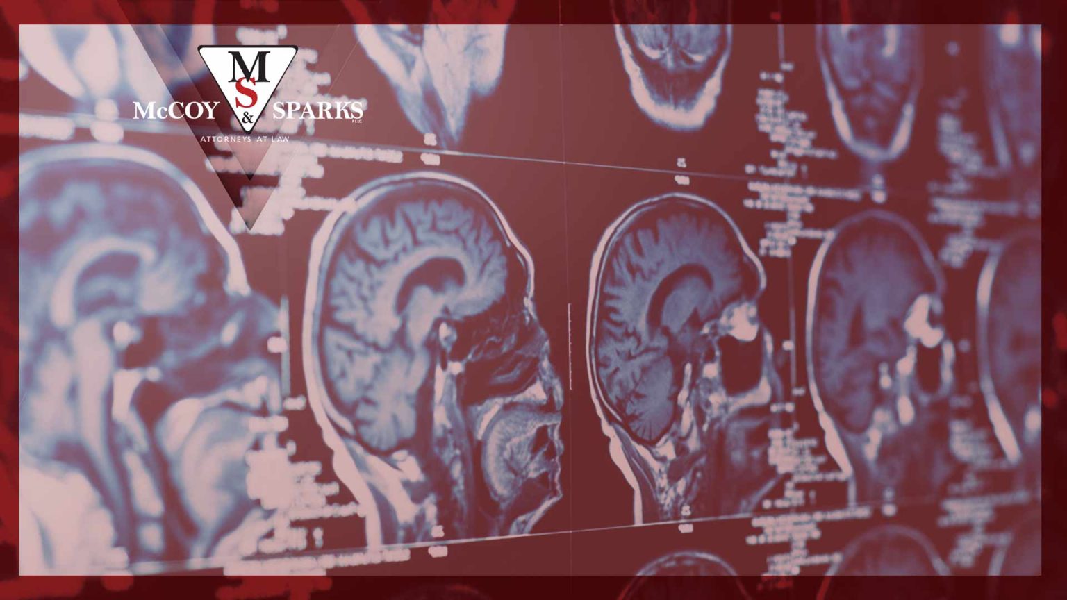 Common Brain Injuries from Car Accident