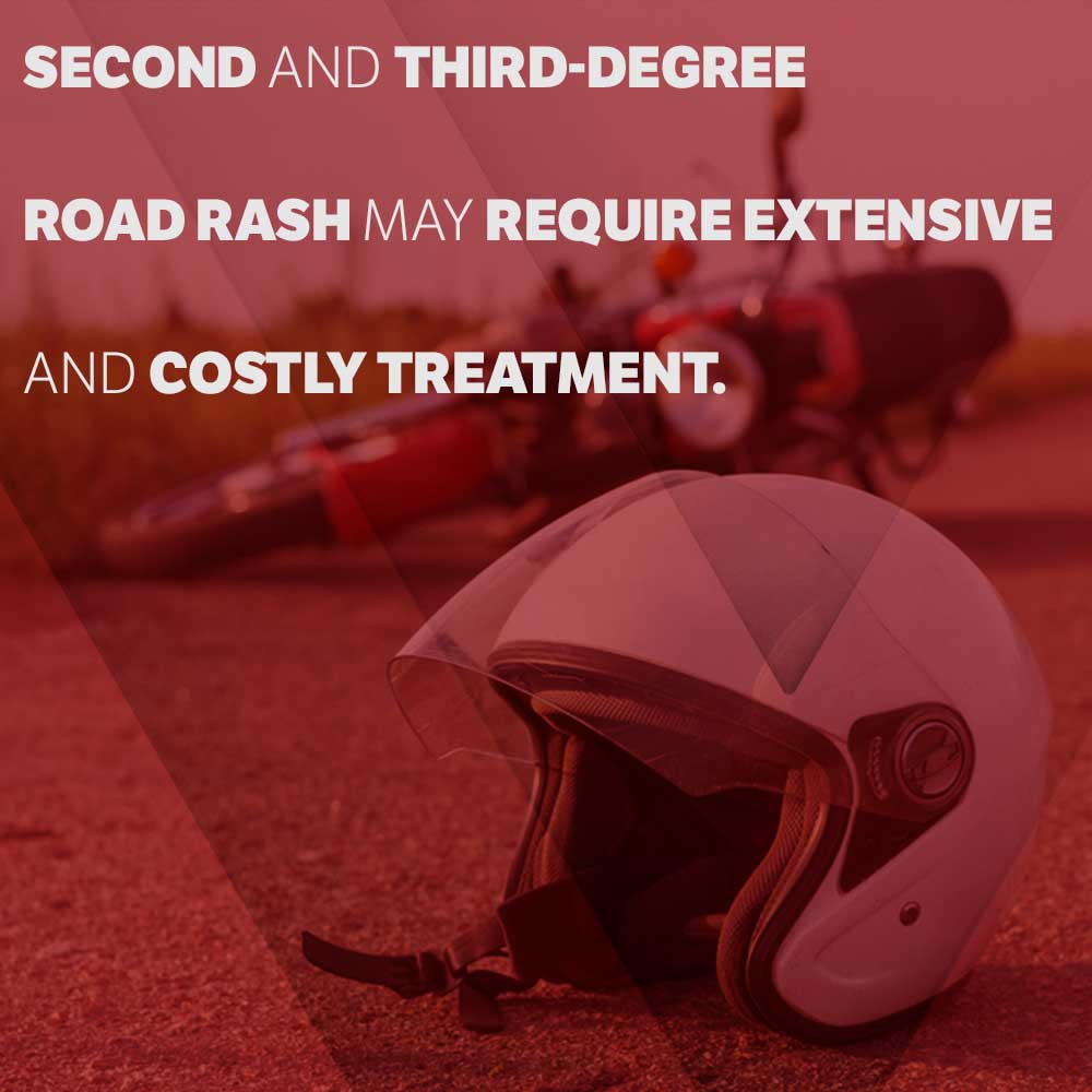 Compensation from Road Rash After a Motorcycle Accident